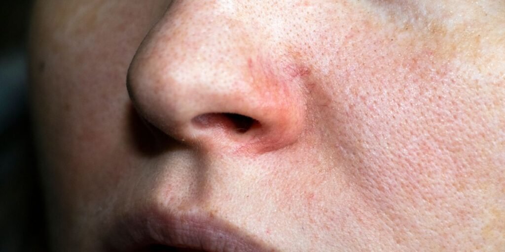 Best Open Pores Treatment in Chennai | Everglo Clinic